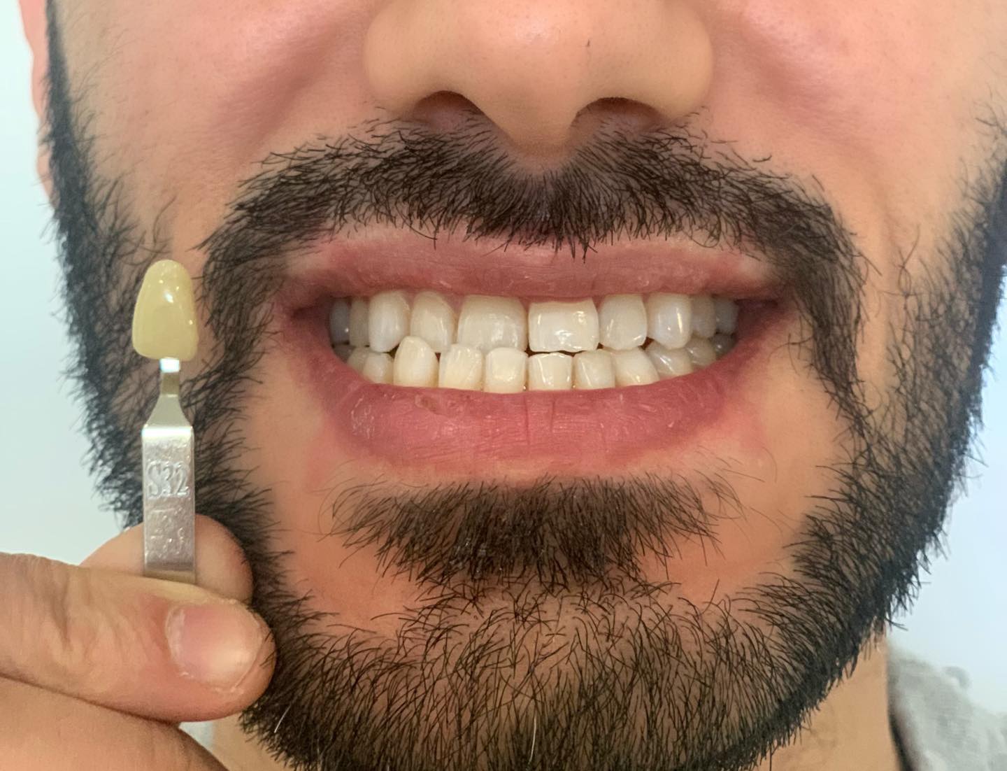 Cosmetic Teeth Whitening at Lashes On Point – Brighter Smiles in Just ...